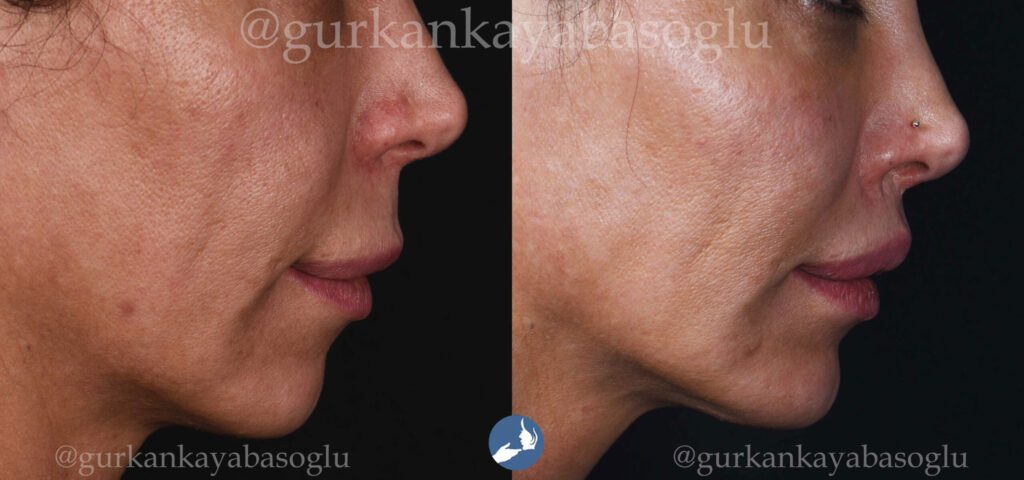 Lip Lift in Turkey - Prof. Dr. Gurkan Kayabasoglu