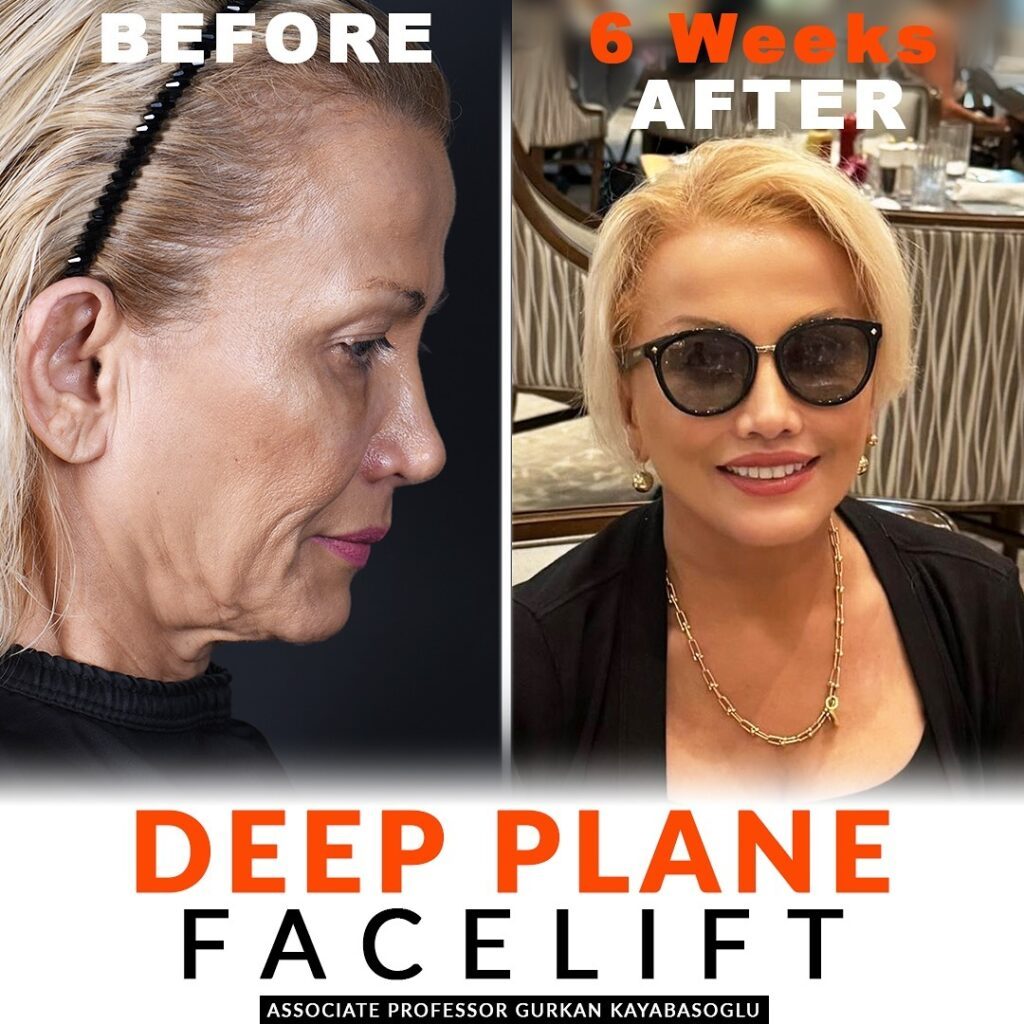 Deep Plane Facelift in Turkey - Prof. Dr. Gurkan Kayabasoglu
