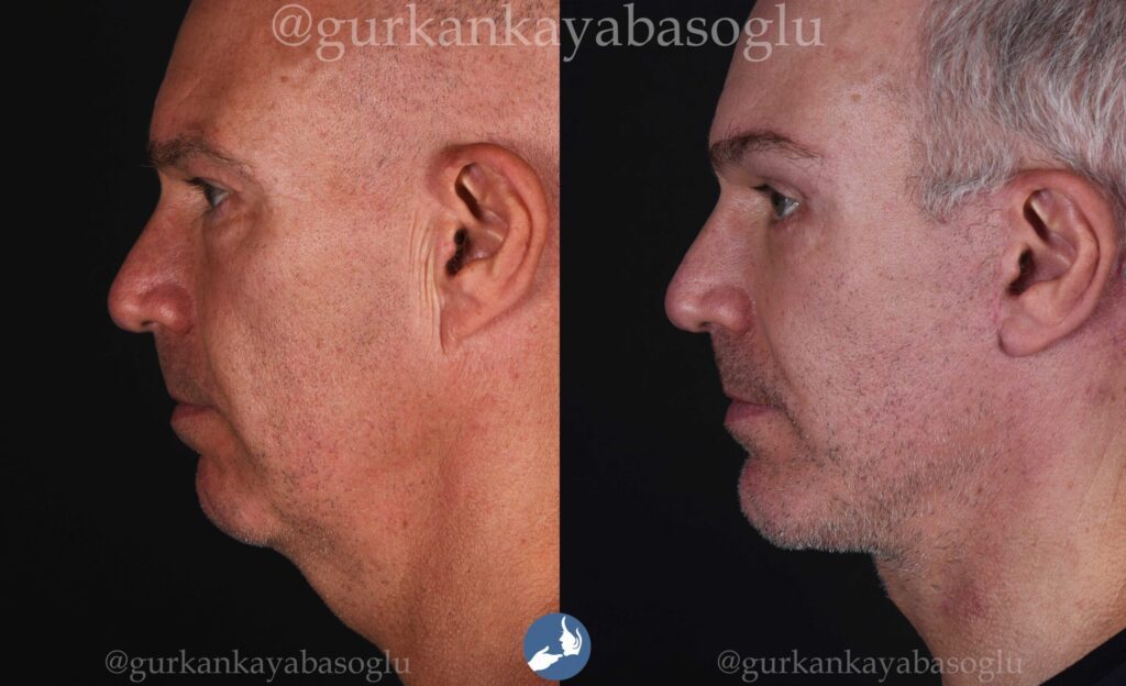 Facelift in Turkey - Assoc. Prof. Gurkan Kayabasoglu