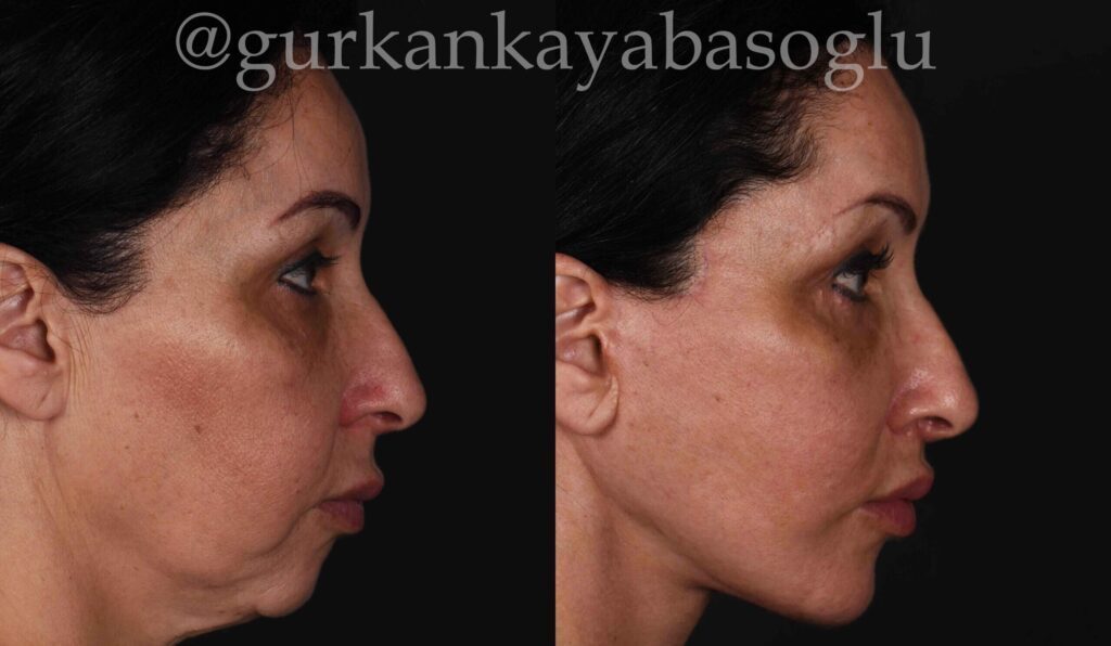 Facelift in Turkey - Assoc. Prof. Gurkan Kayabasoglu